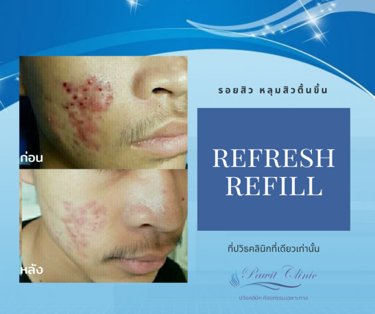 Refresh & Refill – Pawit Clinic
